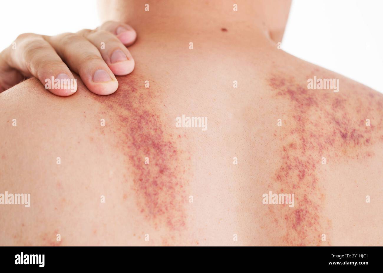 Redness and irritation on the skin of a man s back after a massage ...