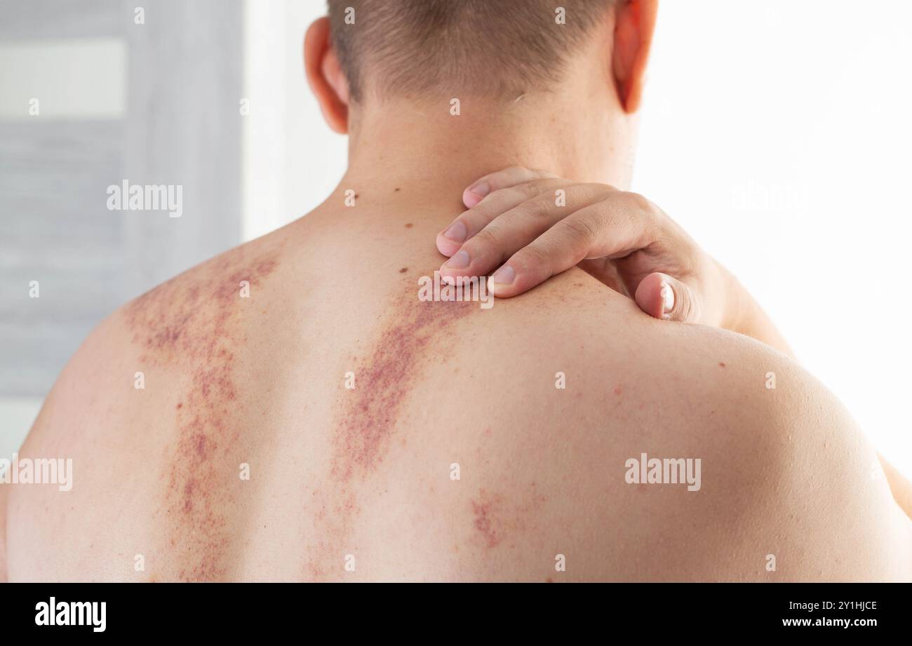 Redness and irritation on the skin of a man s back after a massage ...