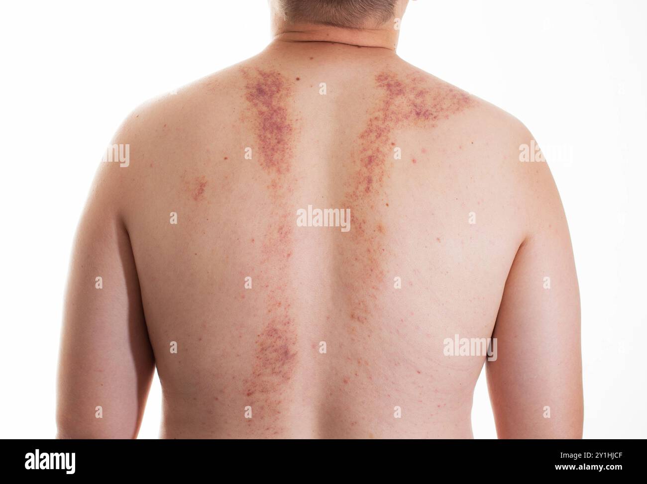 Redness and irritation on the skin of a man s back after a massage ...