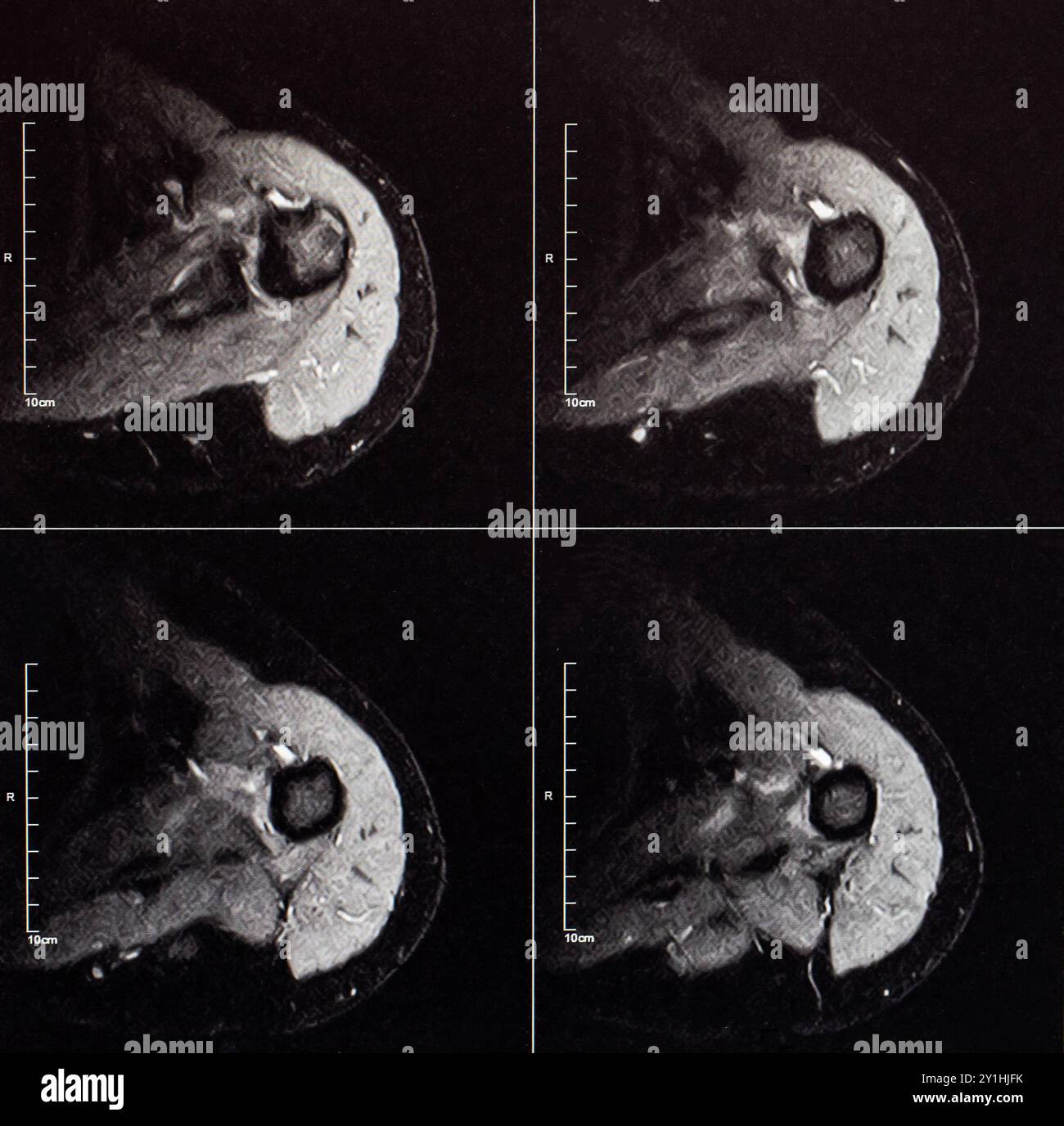 MRI image of the shoulder joint after a fracture and dislocation ...