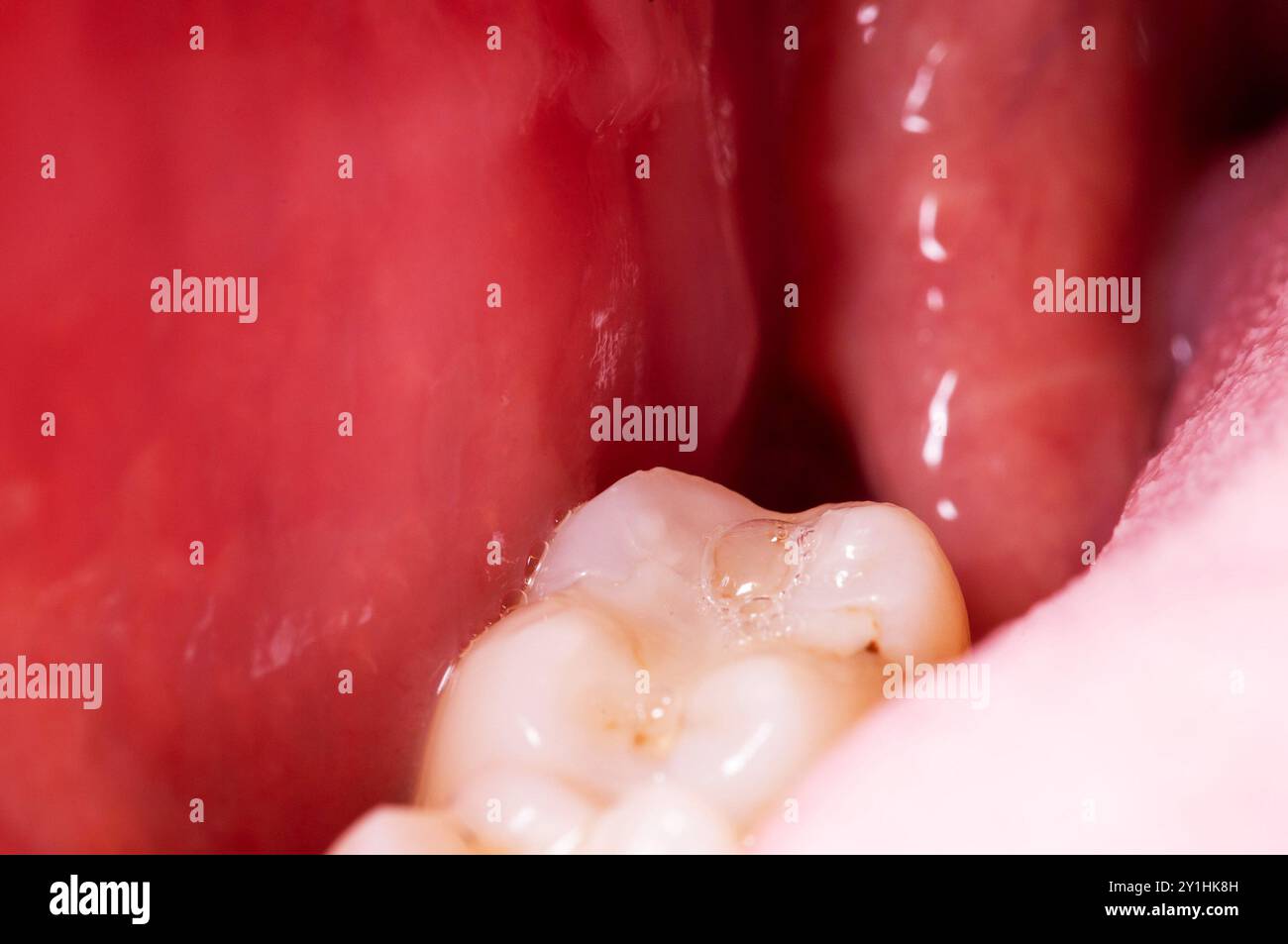 Granulation tissue hi-res stock photography and images - Alamy