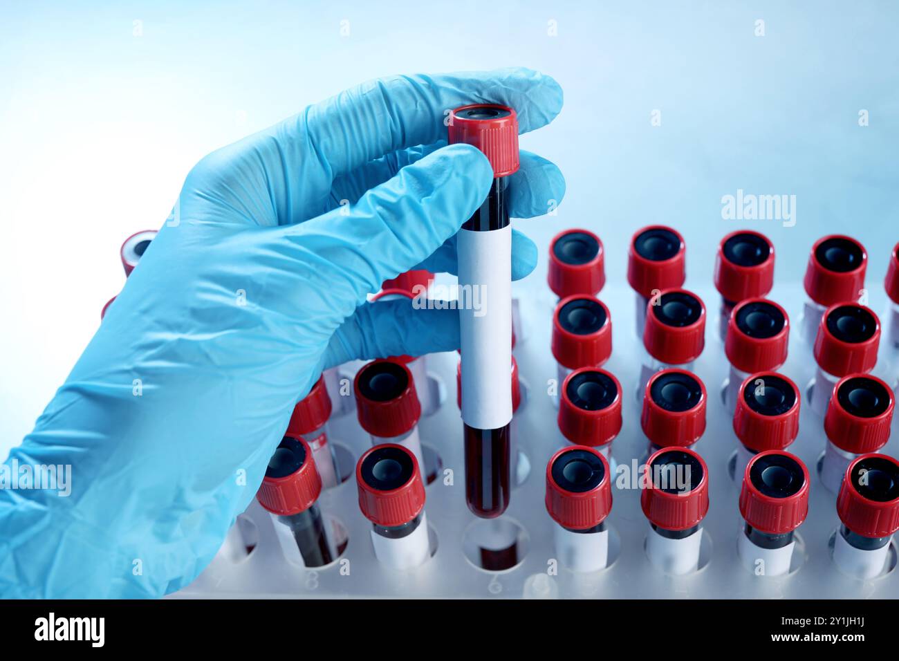 Laboratory worker putting sample tube with blood and blank label into ...