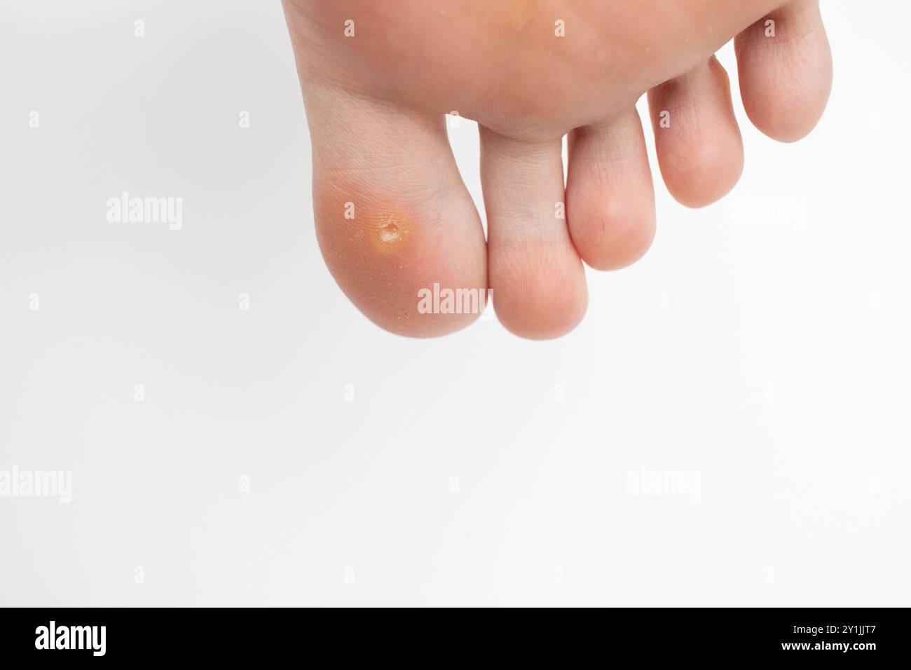 Wart on the big toe foot. HPV virus Stock Photo - Alamy