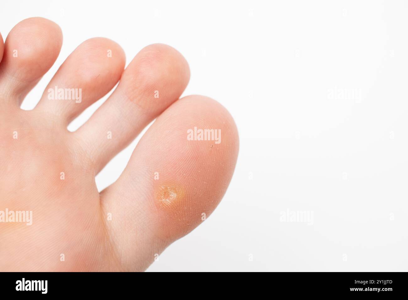 Wart on the big toe foot. HPV virus Stock Photo - Alamy