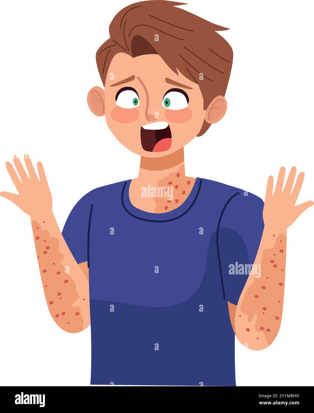 Patient with smallpox Stock Vector Images - Alamy