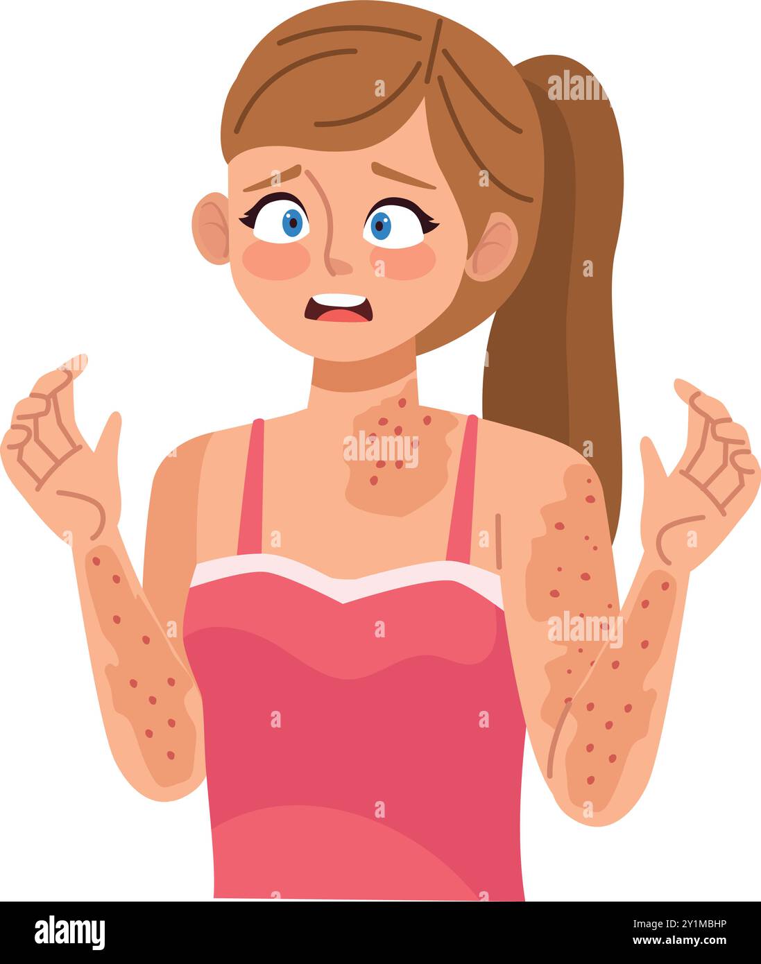 monkeypox infected woman Stock Vector Image & Art - Alamy