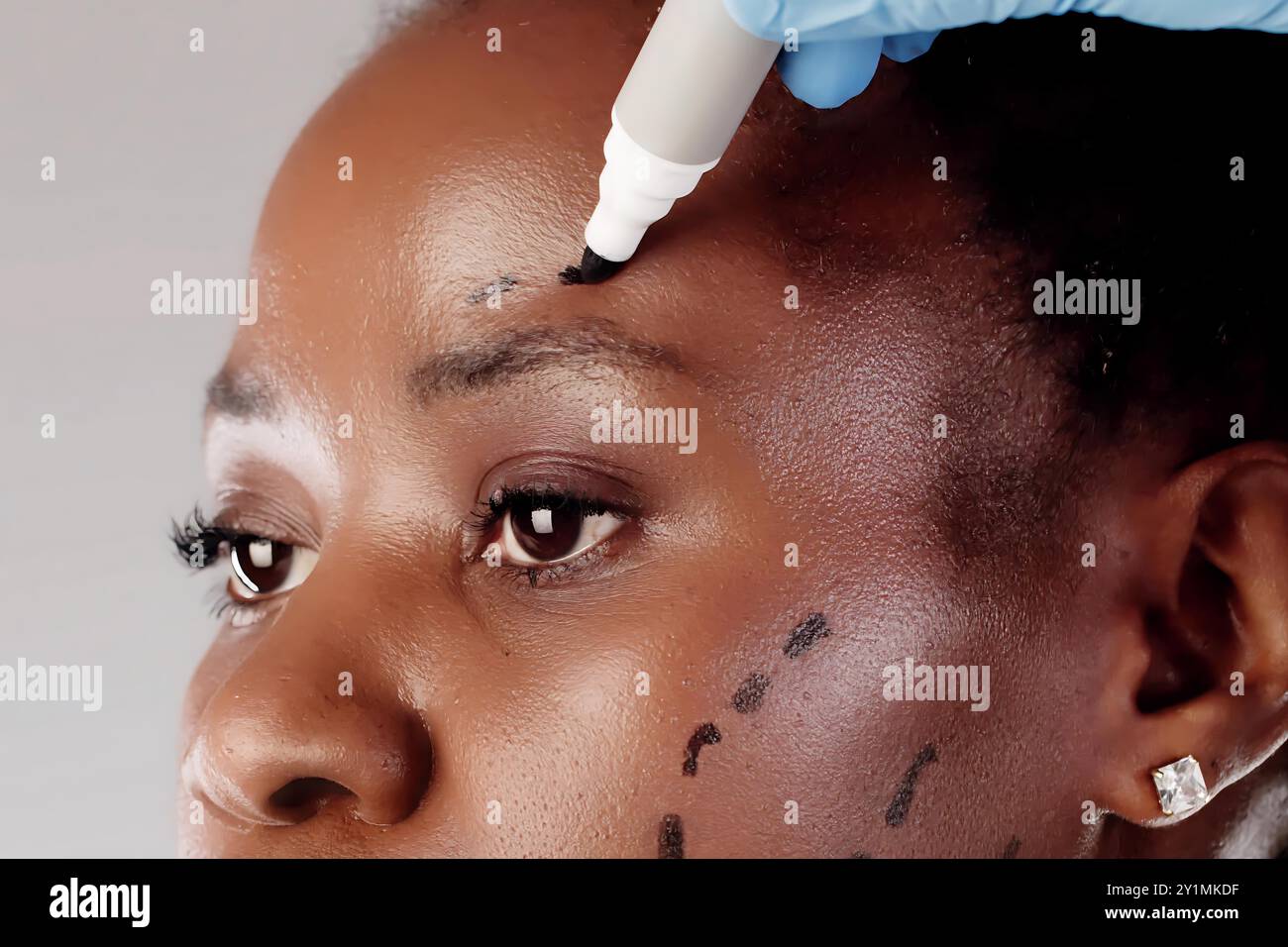 The Aesthetic Journey: A Young Woman Undergoing Facelift Surgery by a ...