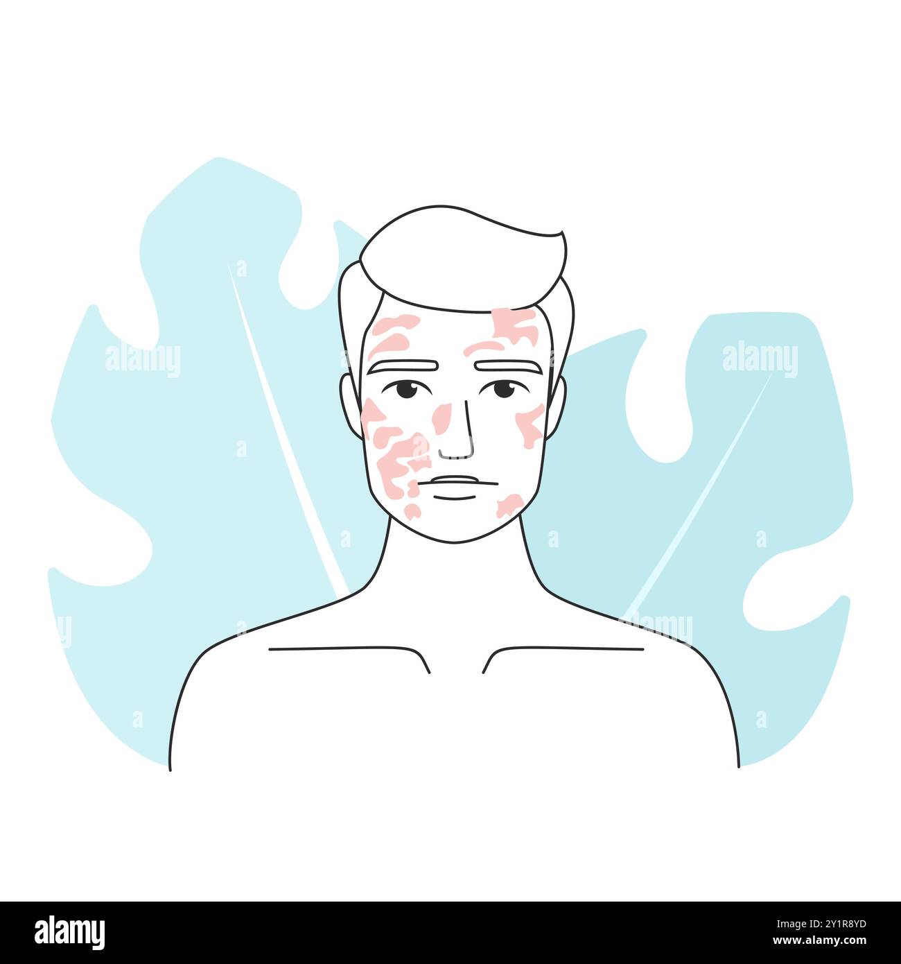 Vector illustration of a male portrait with acne and a light blue ...