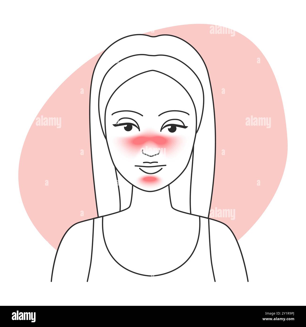 Vector illustration of a female portrait with rosacea and a light pink ...