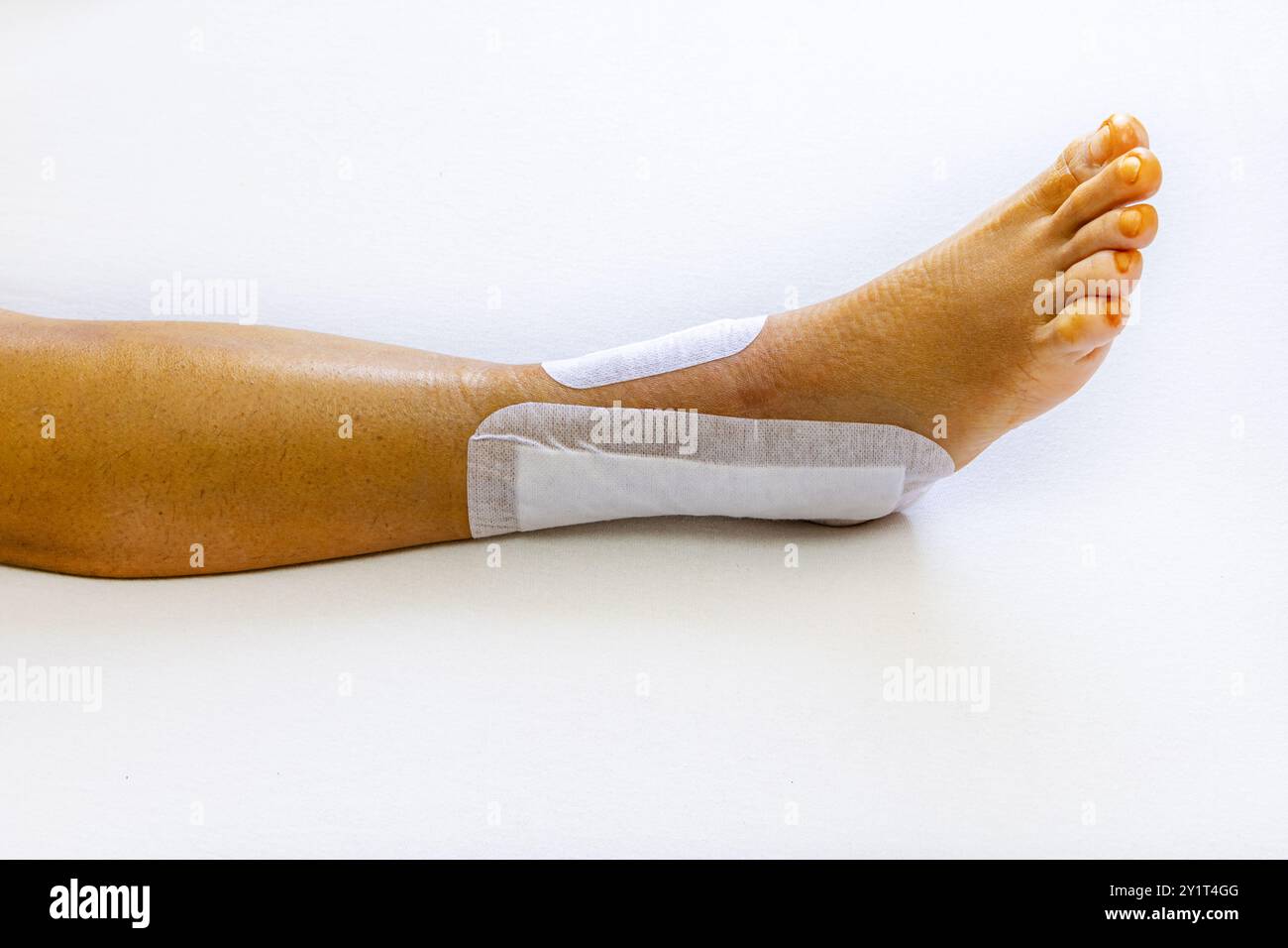 Right leg after surgery to repair a dislocated ankle joint and connect ...