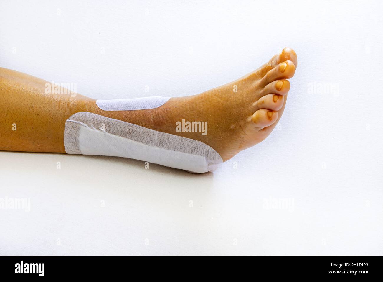 Right leg after surgery to repair a dislocated ankle joint and connect ...