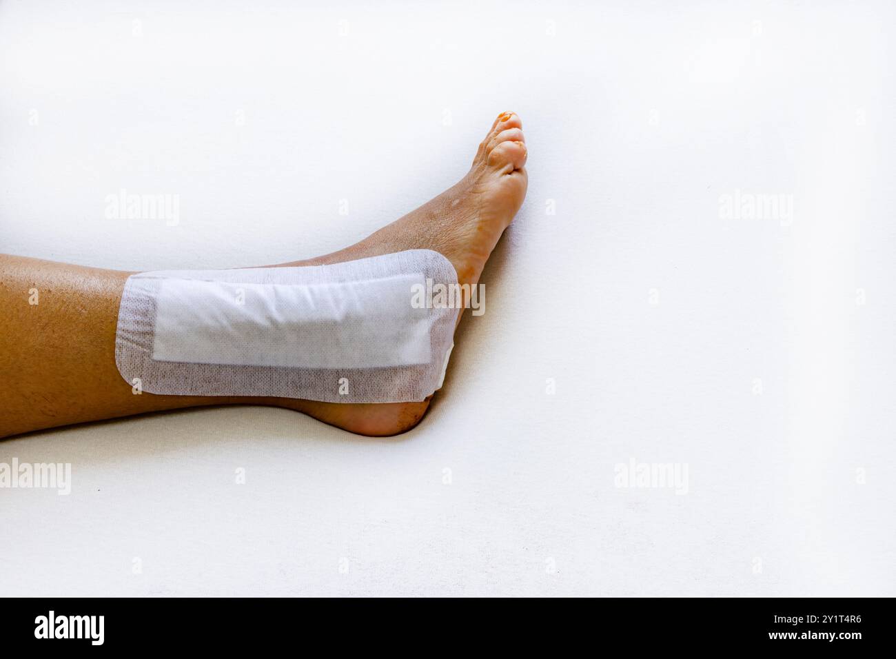 Right leg after surgery to repair a dislocated ankle joint and connect ...