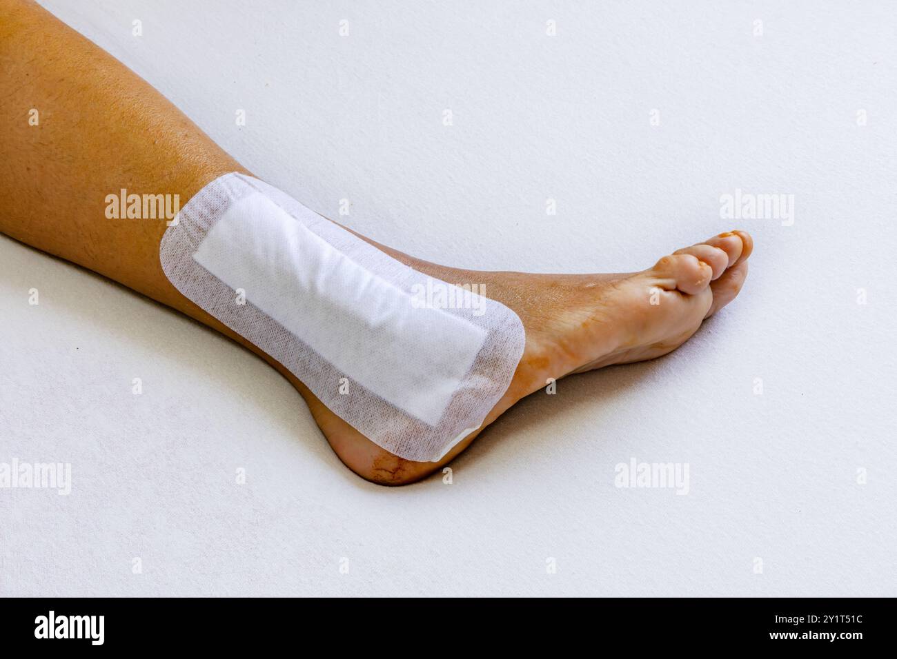 Right leg after surgery to repair a dislocated ankle joint and connect ...