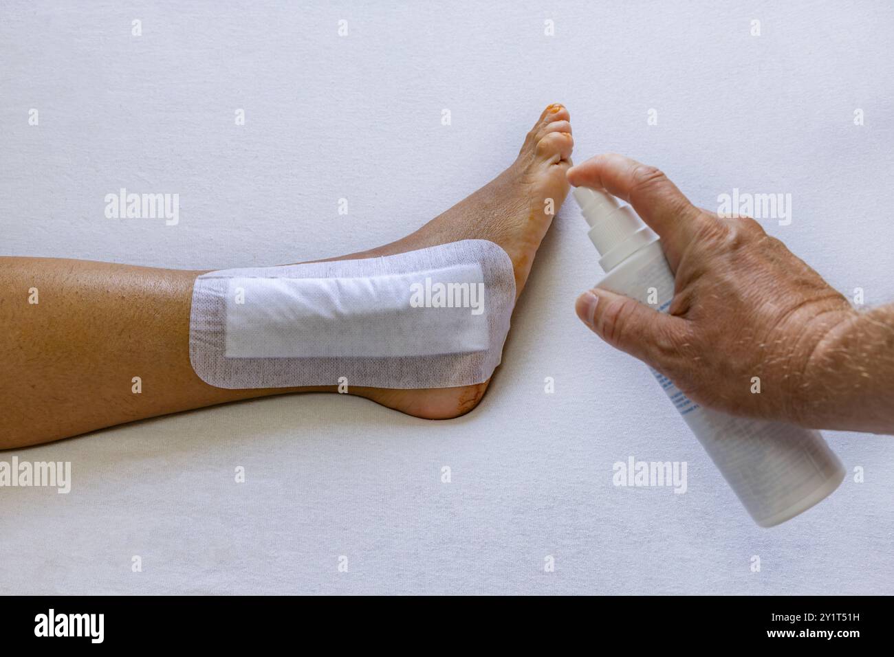 Right leg after surgery to repair a dislocated ankle joint and connect ...