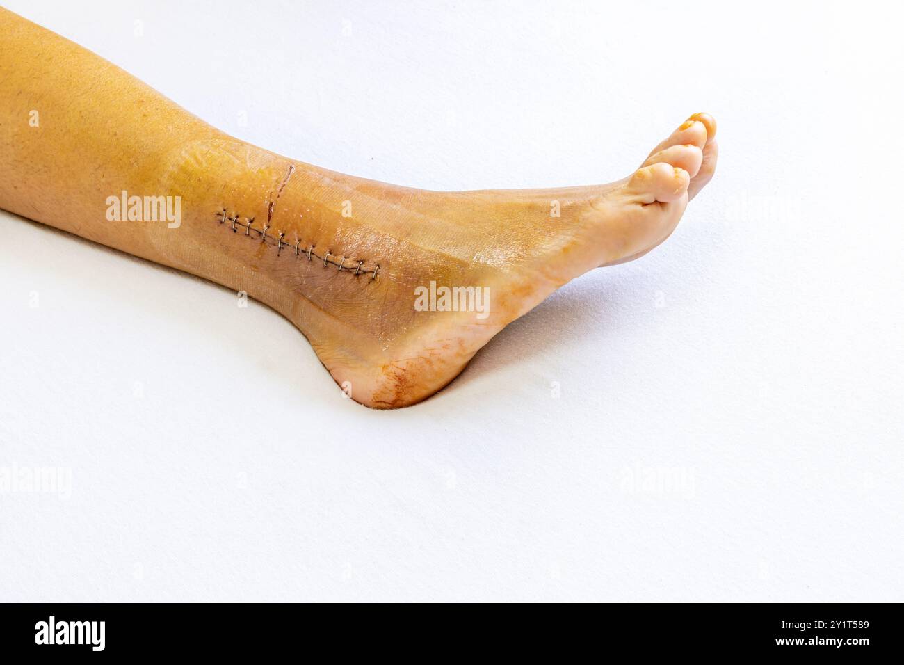 Right leg surgery, dislocated ankle, broken foot bone, stitches ...