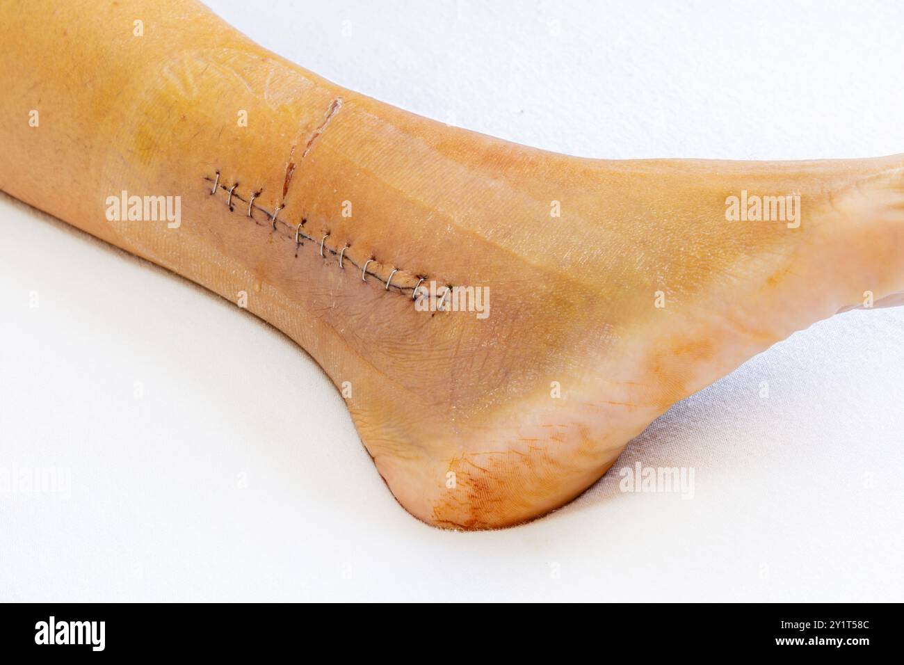 Right leg surgery, dislocated ankle, broken foot bone, stitches ...