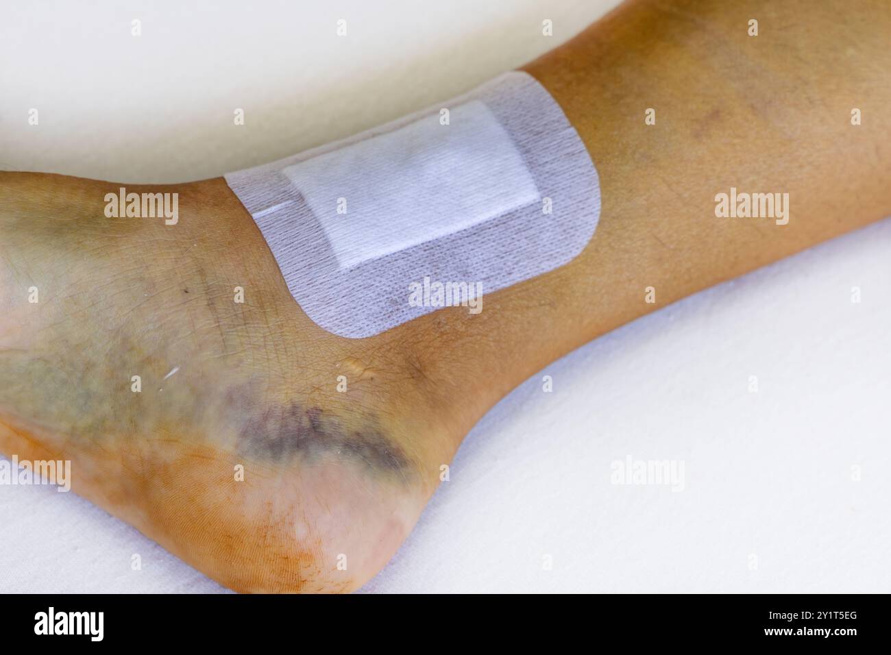 Right leg after surgery to repair a dislocated ankle joint and connect ...