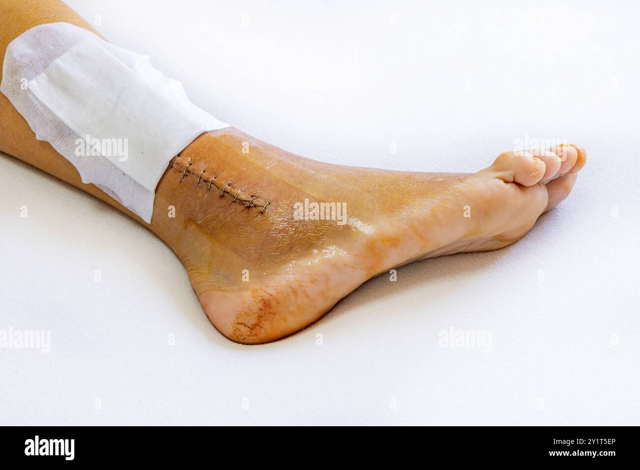 Right leg after surgery to repair a dislocated ankle joint and connect ...