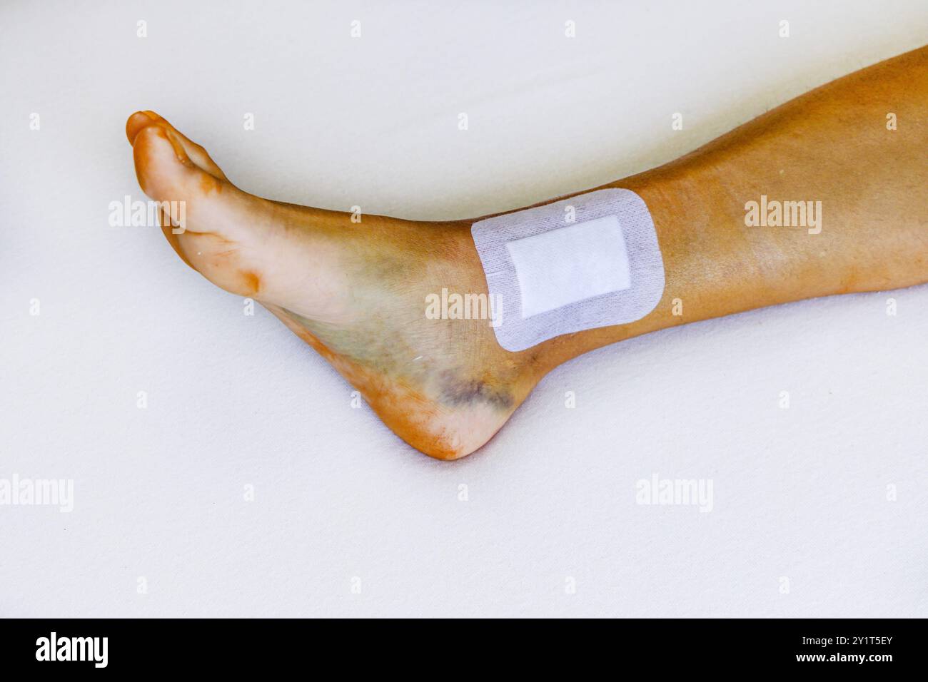 Right leg after surgery to repair a dislocated ankle joint and connect ...