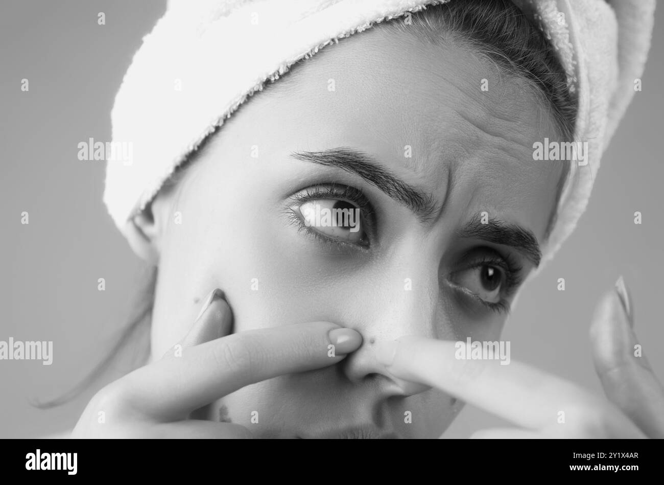 Acne. Close up acne pimple on female skin. Dermatology, puberty woman ...