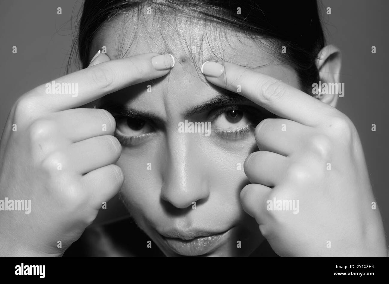 Pustule acne. Close up pimple on female skin. Dermatology, puberty ...