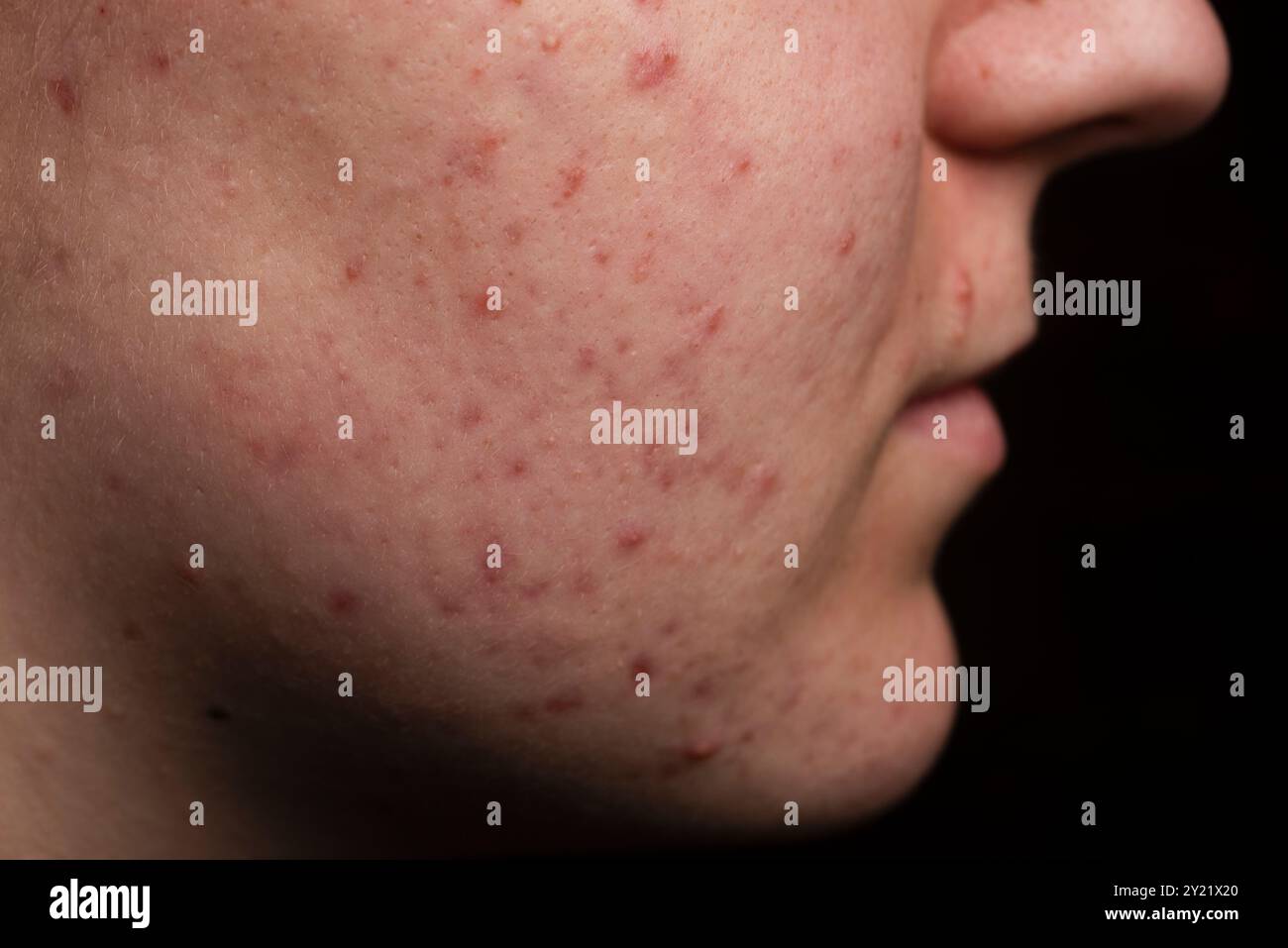 Pimple on face. Skin texture. Closeup acne skin. Treatment for skin ...