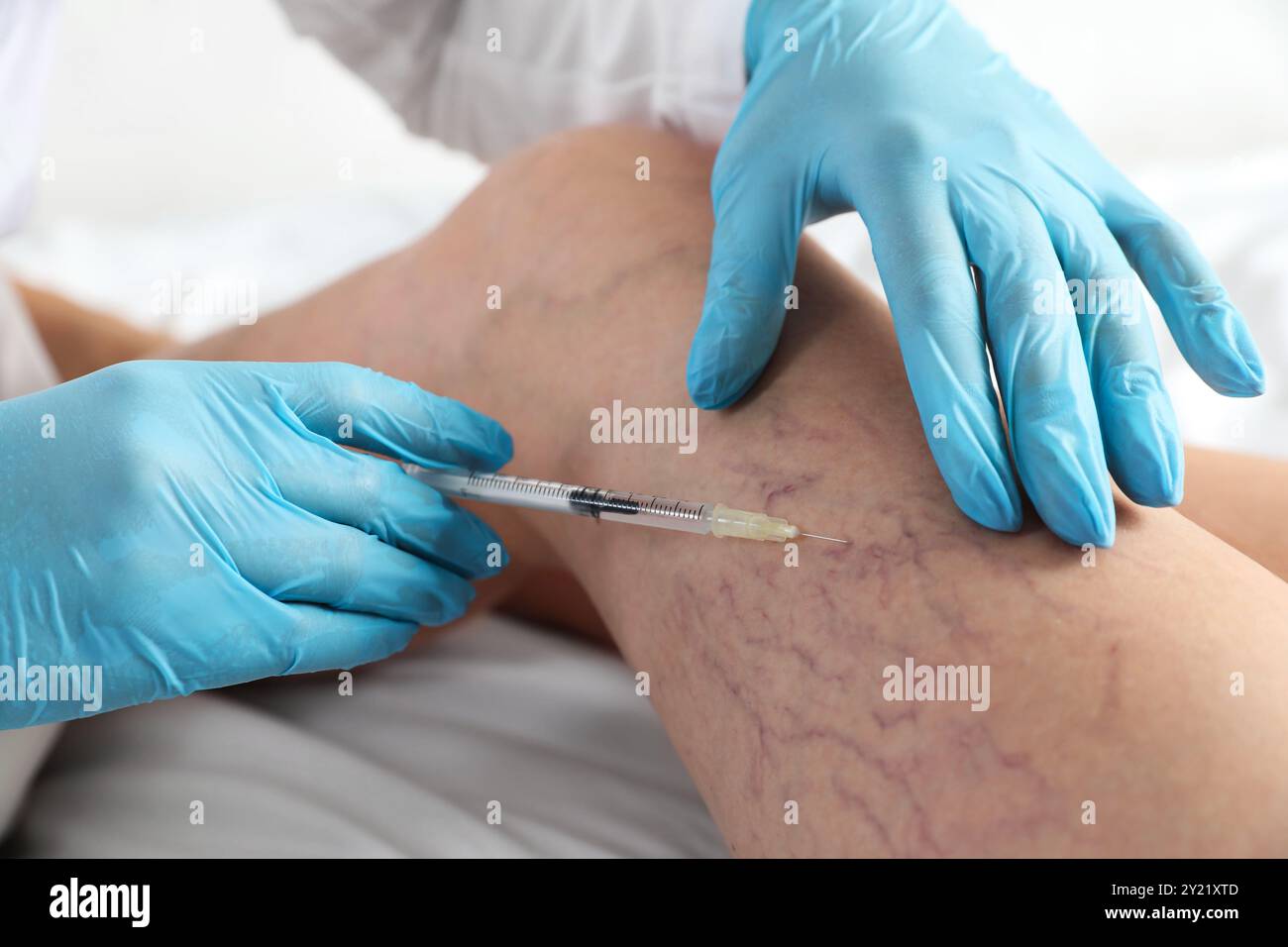 Varicose veins treatment. Doctor giving injection to patient indoors ...