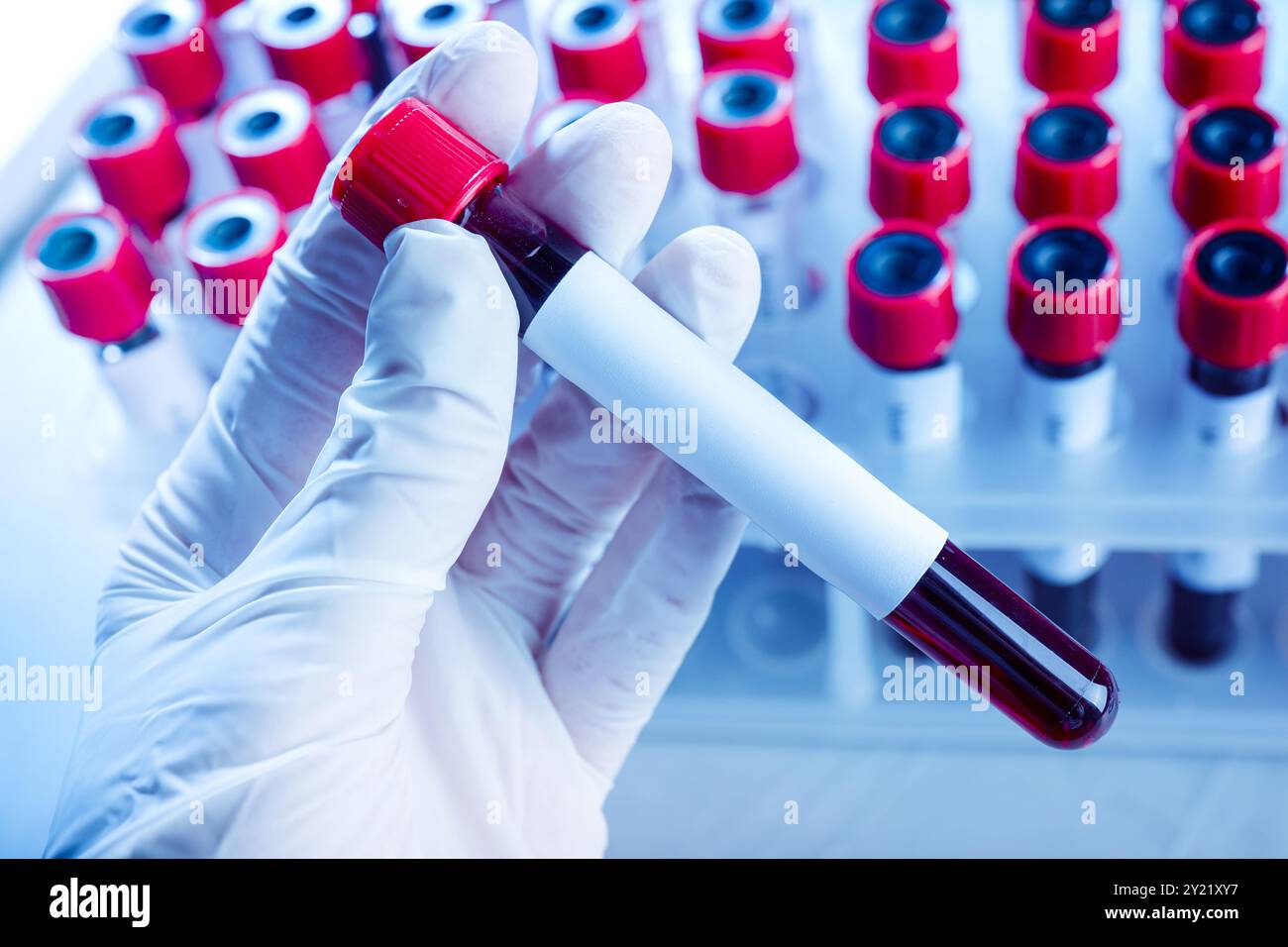Laboratory worker putting sample tube with blood and blank label near ...