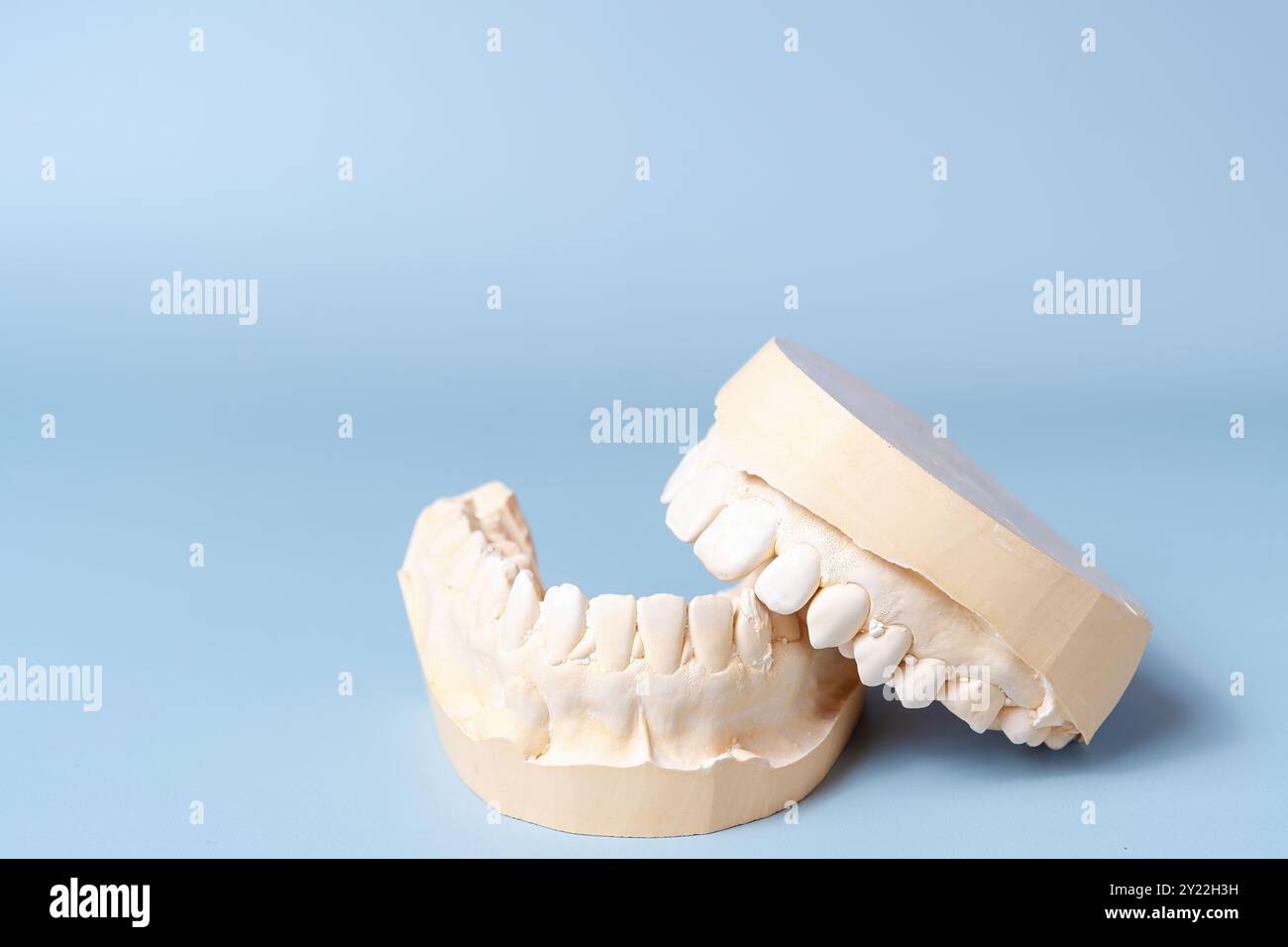 Close-up of a dental jaw mold with teeth on a blue background. It's a ...
