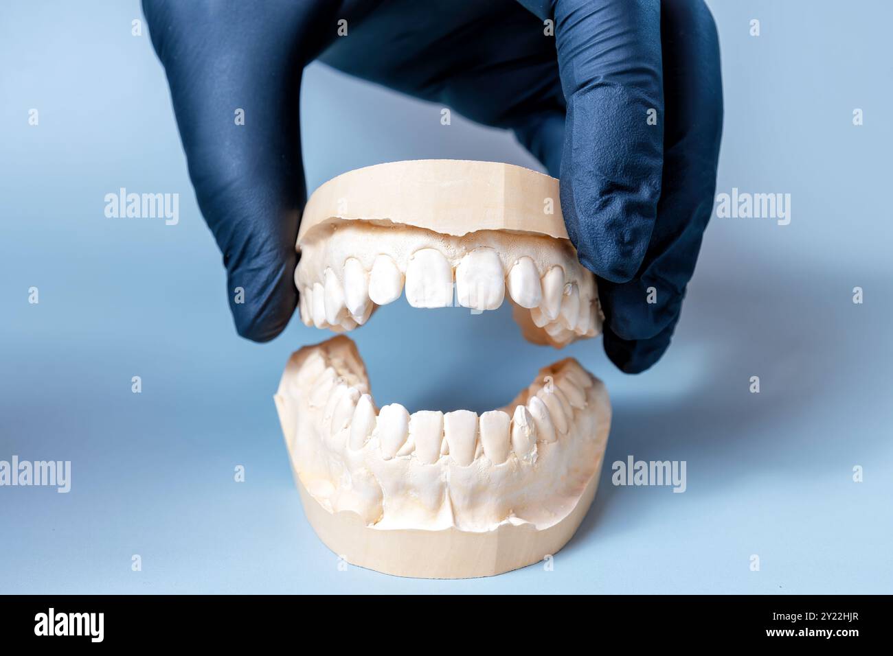 A gloved hand holds a dental plaster mold of teeth. The mold shows the ...