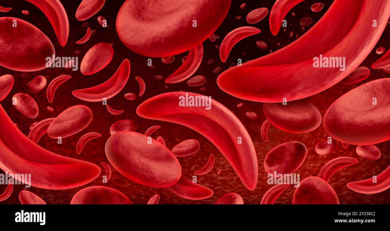 Sickle cell anemia as a red blood disease as a normal and abnormal ...