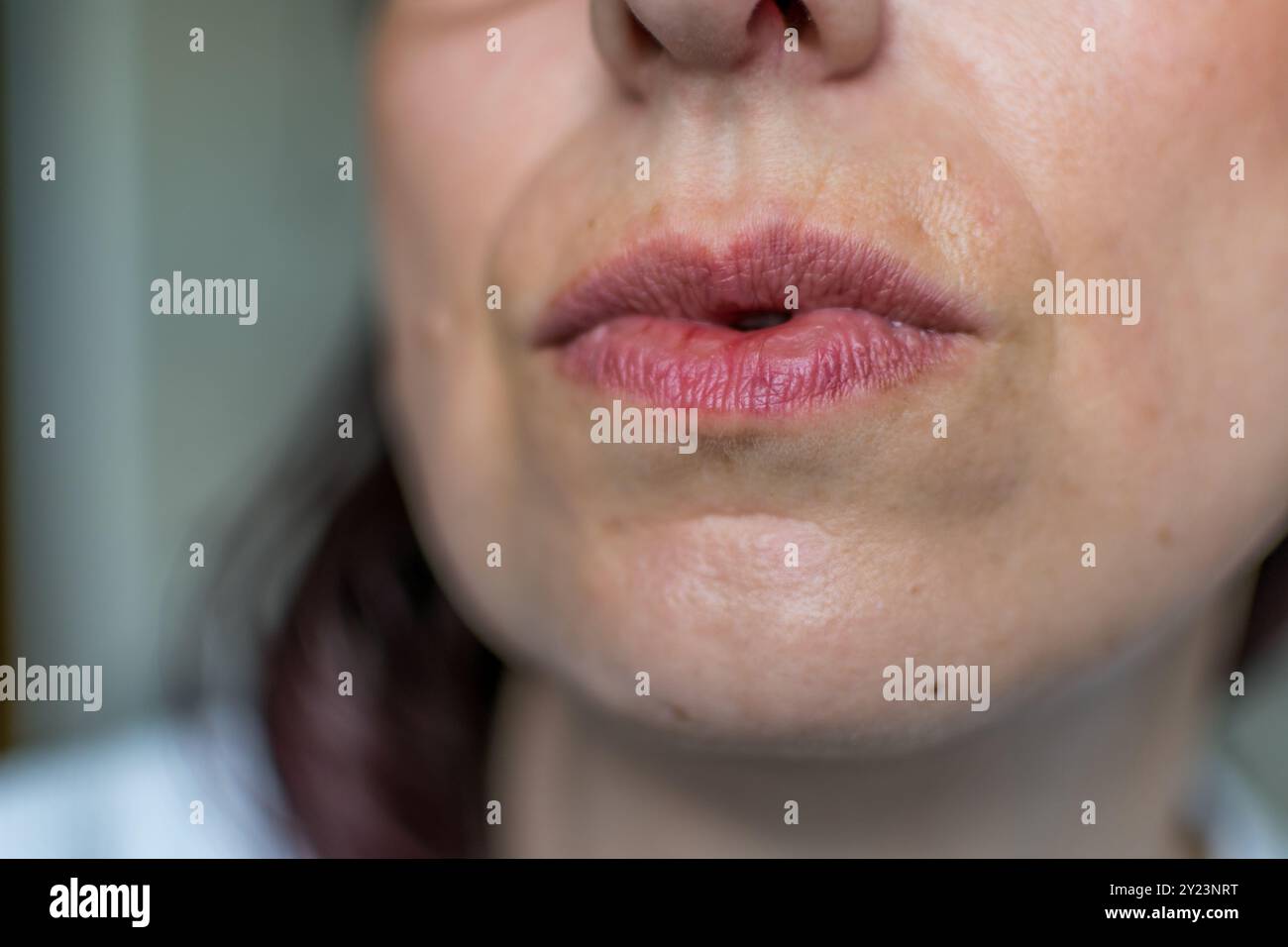 Scar lip hi-res stock photography and images - Alamy