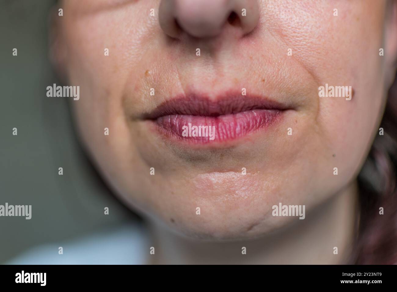 Scar lip hi-res stock photography and images - Alamy