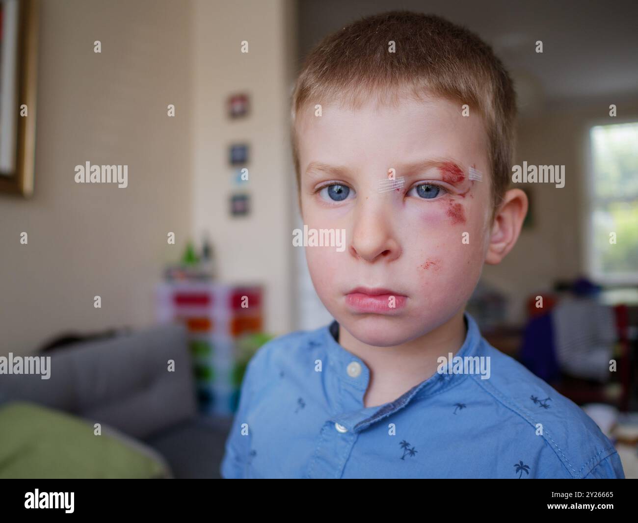 Portrait of small five year old boy with facial injury, cuts, bruises ...
