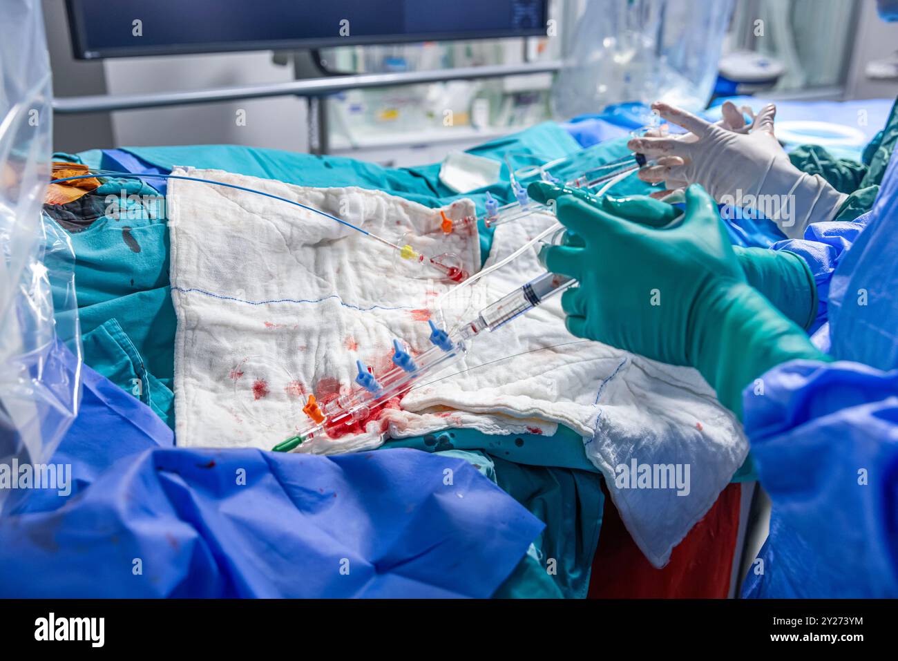 The procedure of inserting a double lumen catheter into a patient with ...