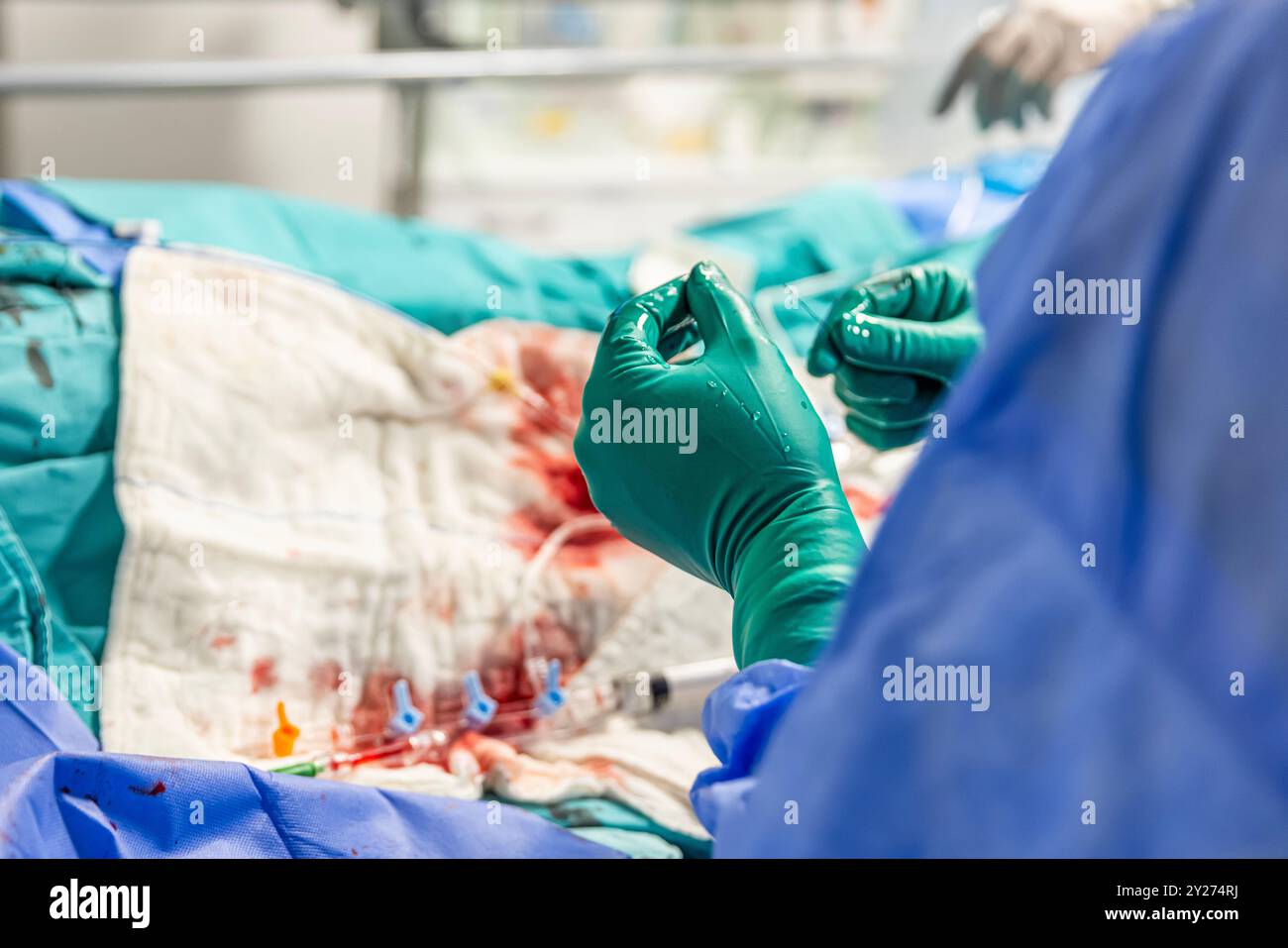 The procedure of inserting a double lumen catheter into a patient with ...