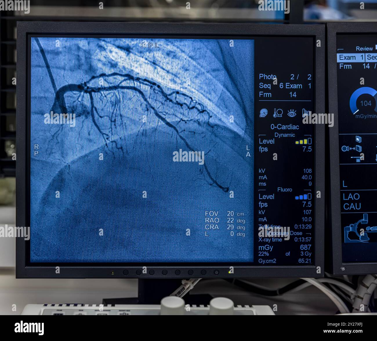 Chest x ray angiogram hi-res stock photography and images - Alamy