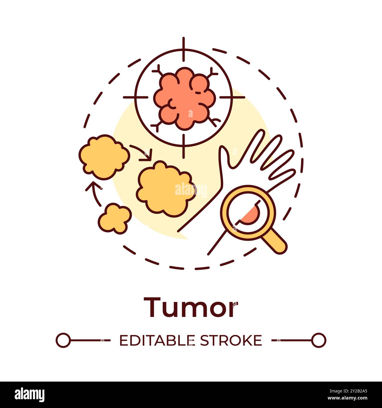 Tumor neoplasm hi-res stock photography and images - Alamy