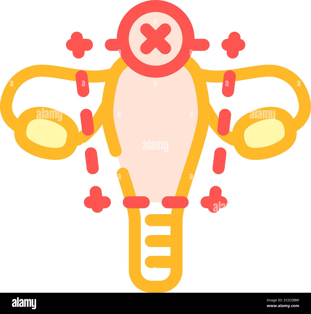 Hysterectomy procedure hi-res stock photography and images - Alamy