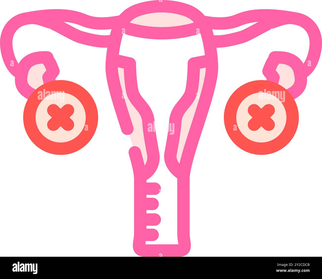 Oophorectomy hi-res stock photography and images - Alamy