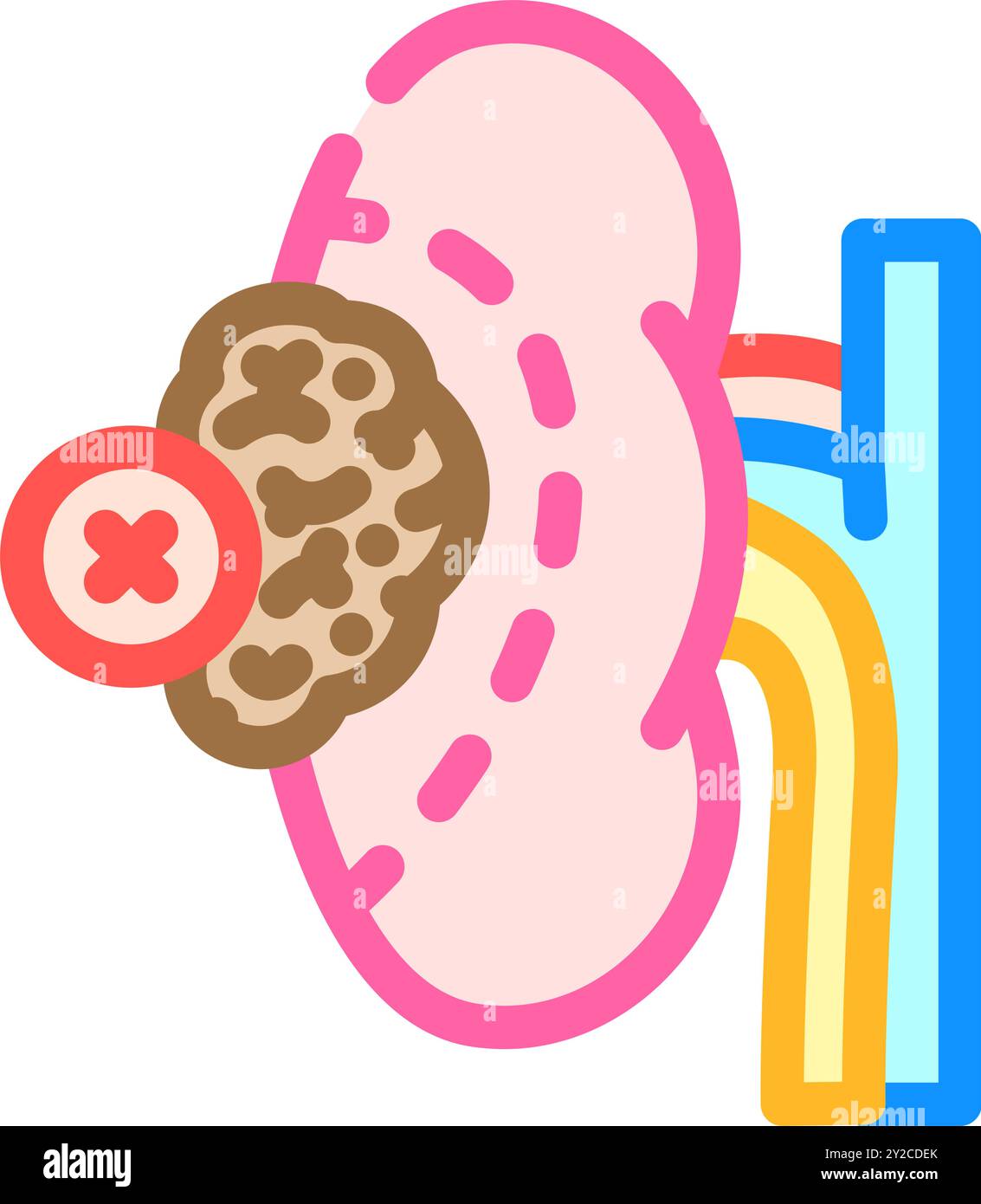 Nephrectomy hi-res stock photography and images - Alamy