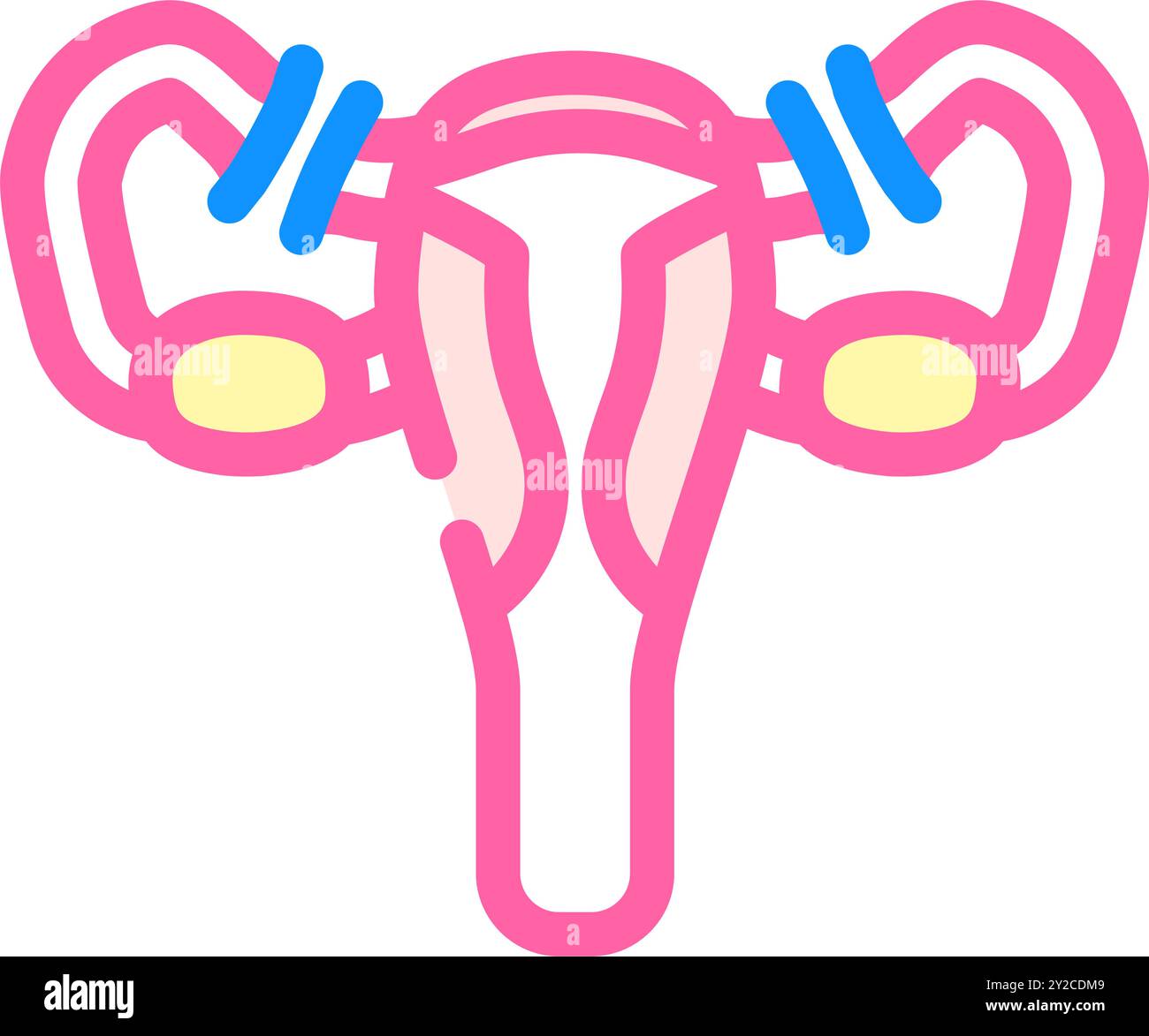 tubal ligation surgery color icon vector illustration Stock Vector ...
