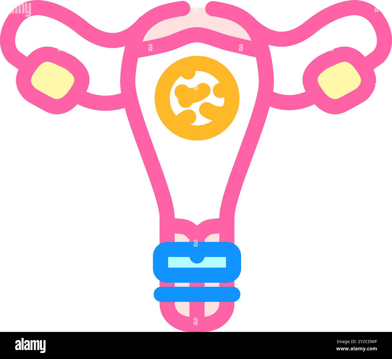 cervical cerclage surgery color icon vector illustration Stock Vector ...