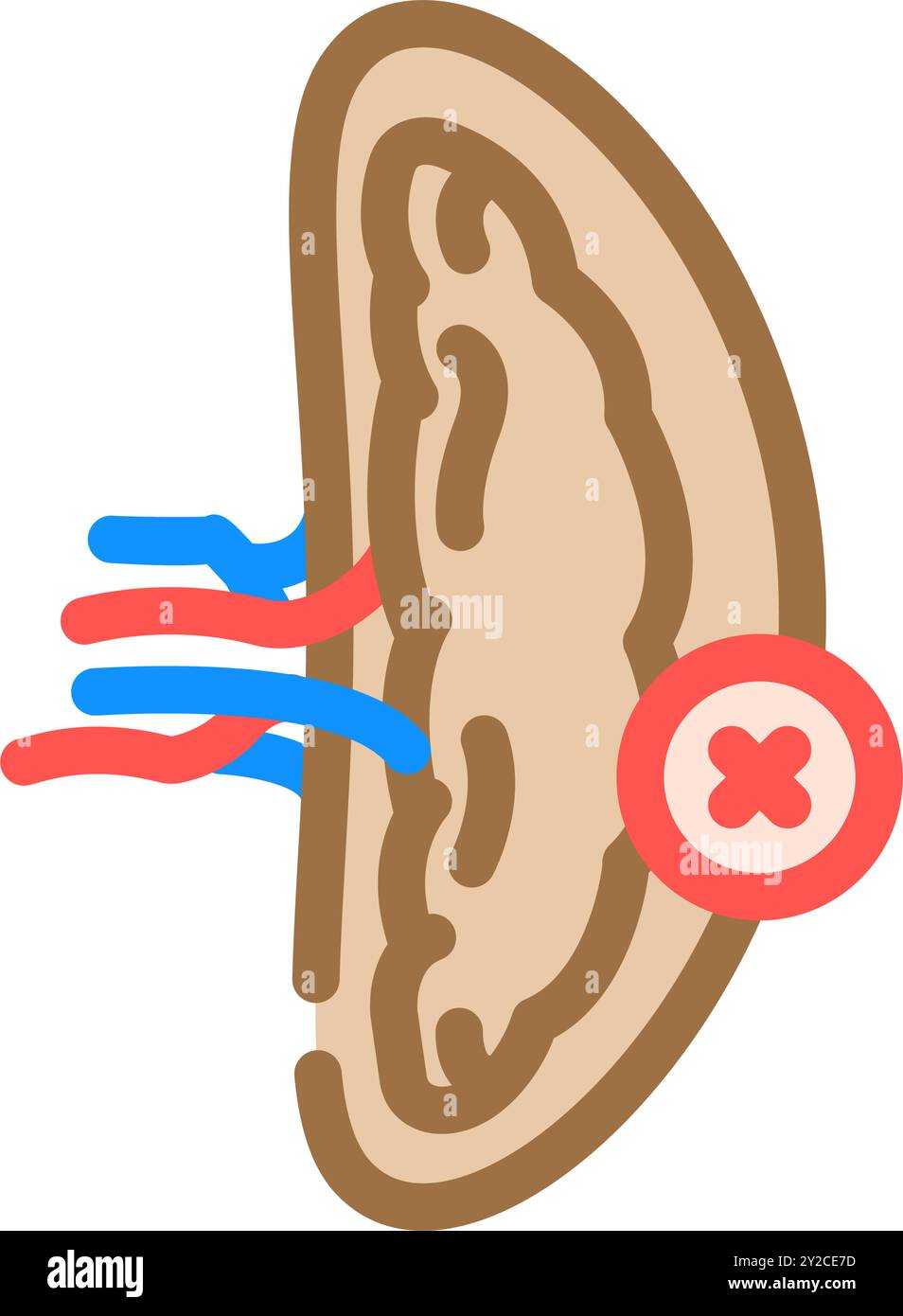 Splenectomy hi-res stock photography and images - Alamy