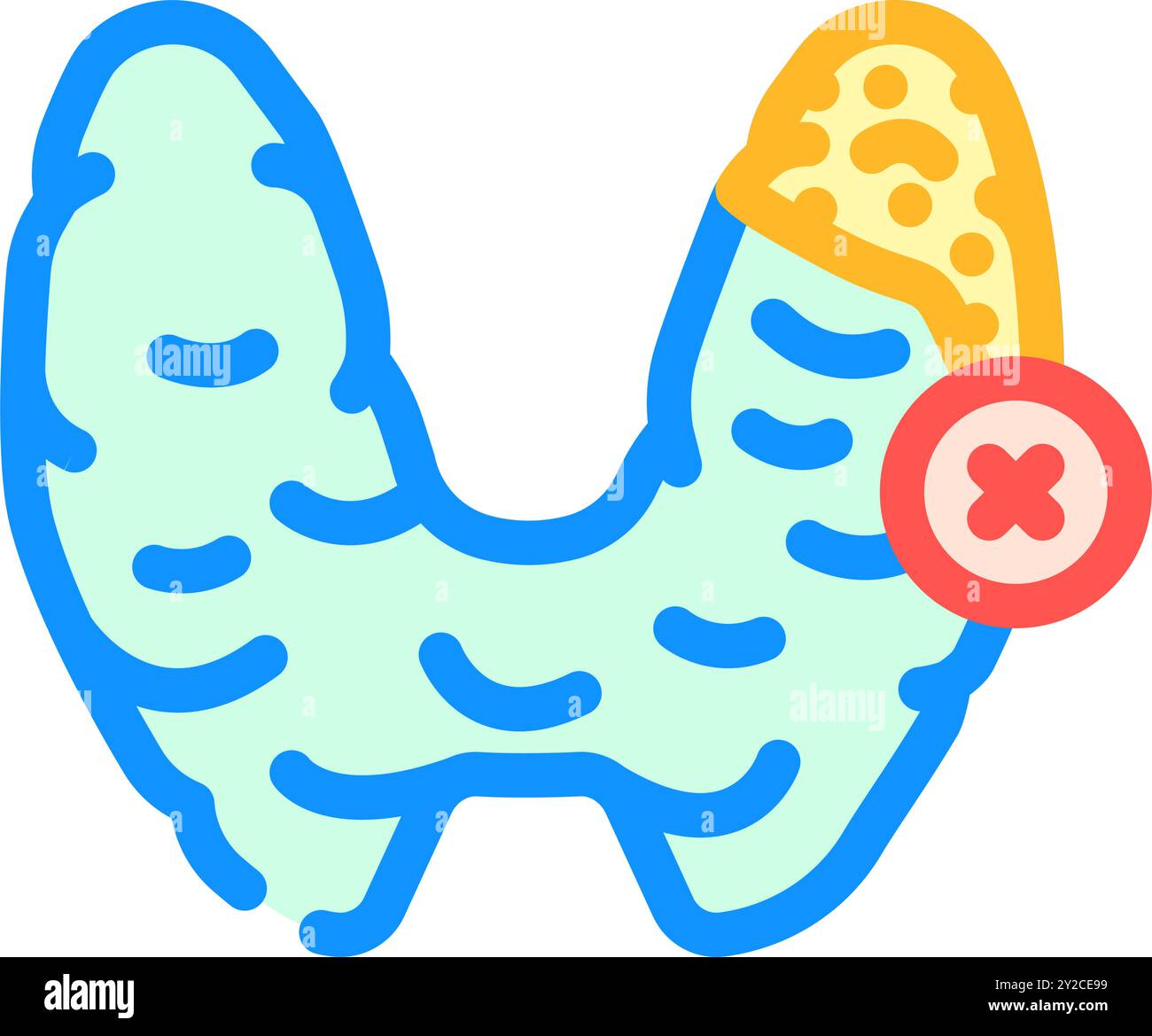 Thyroidectomy Stock Vector Images - Alamy