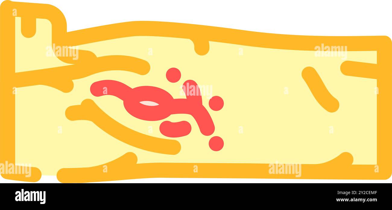 lymph node dissection surgery color icon vector illustration Stock ...