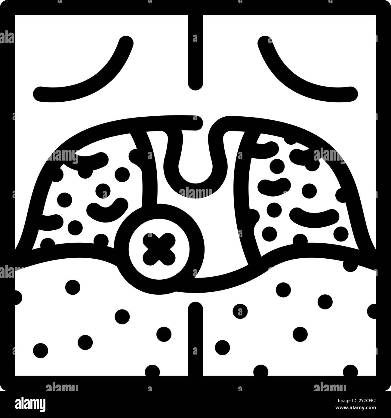 Tonsillectomy hi-res stock photography and images - Alamy