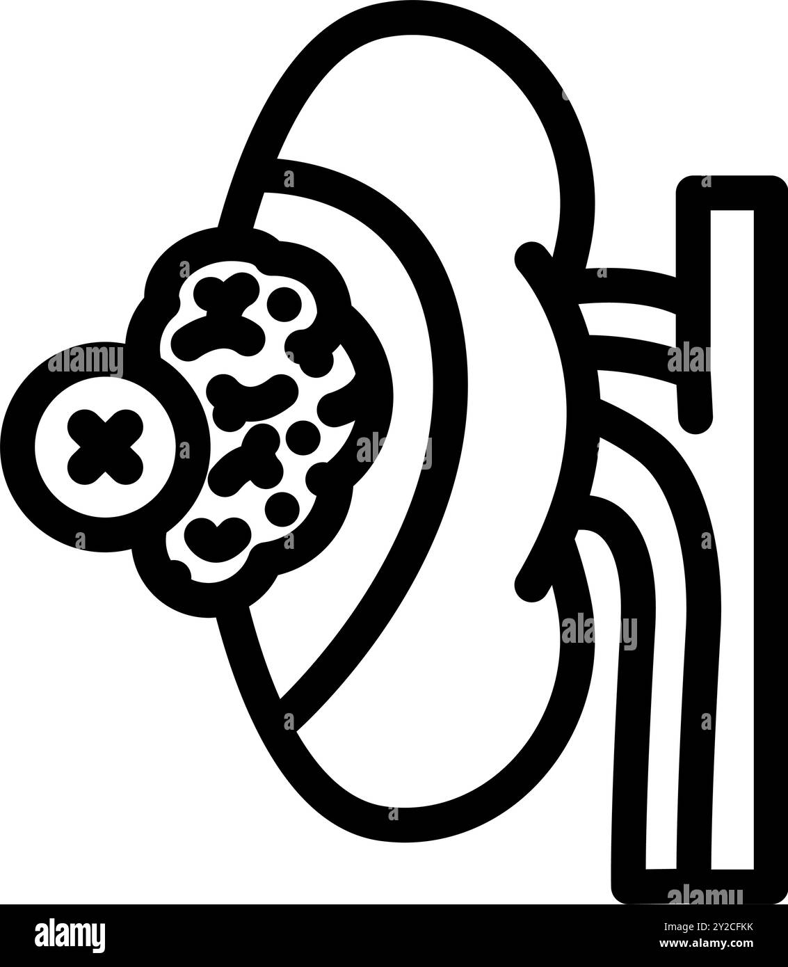 nephrectomy surgery line icon vector illustration Stock Vector Image ...