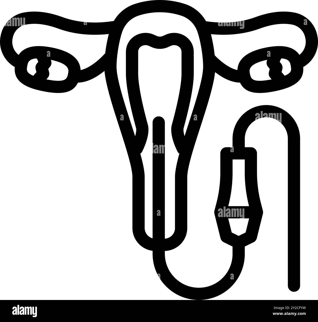 Hysteroscopy hi-res stock photography and images - Alamy