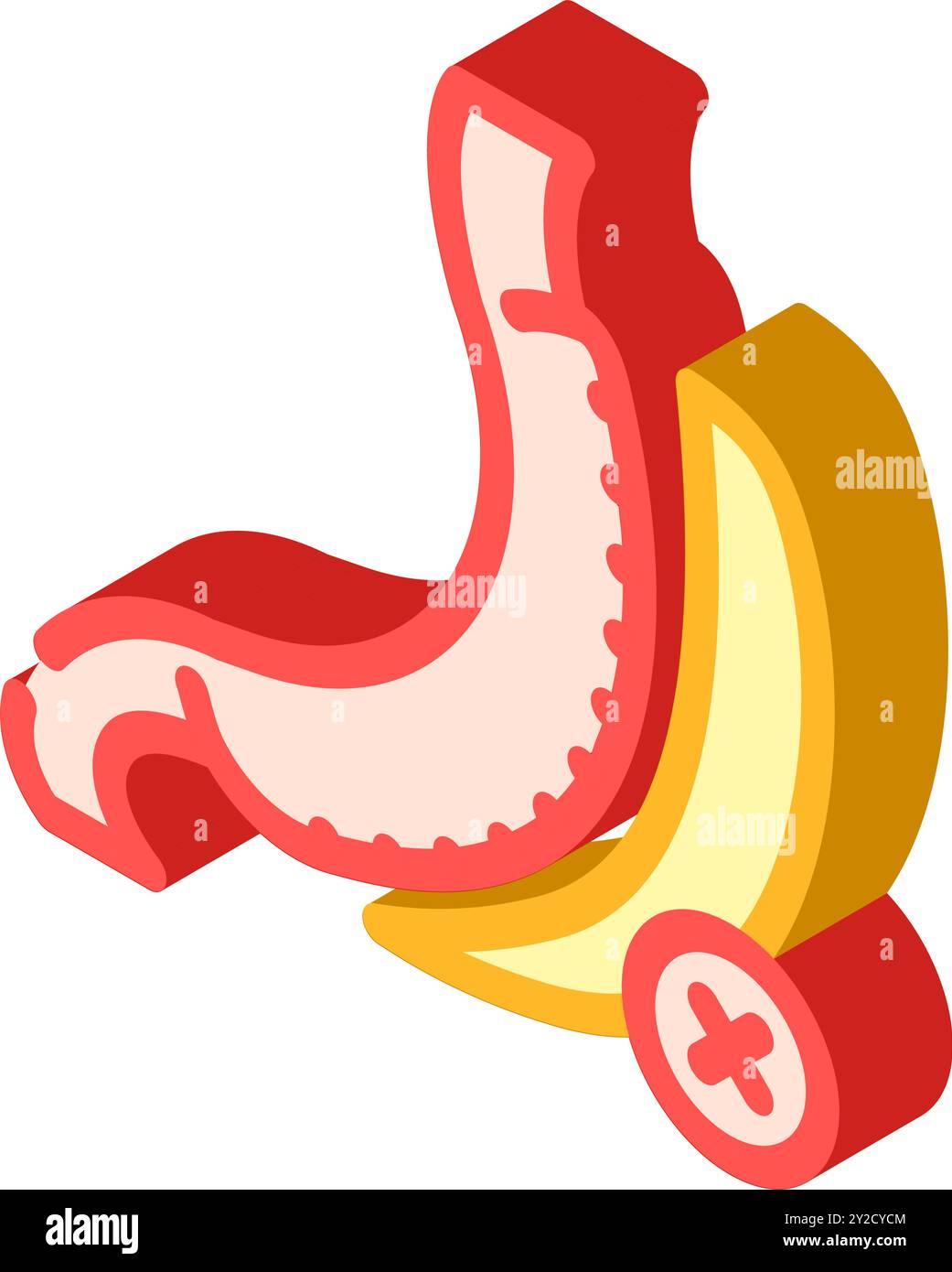 gastrectomy surgery isometric icon vector illustration Stock Vector ...
